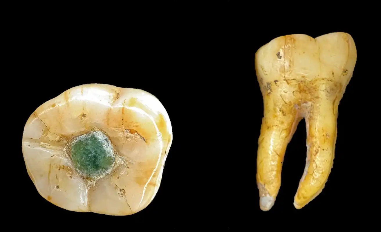 Ancient Maya Dentistry: First Evidence of Gemstone Filling in a Molar ...
